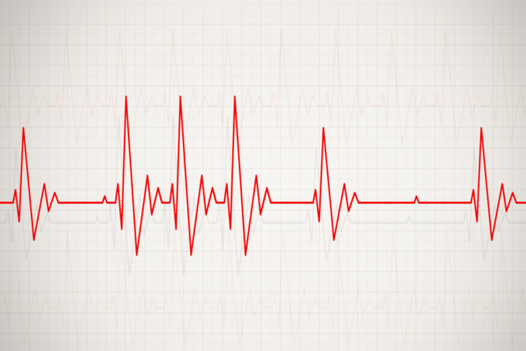 8 Heart Arrhythmia Symptoms To Watch Out For - Viedial
